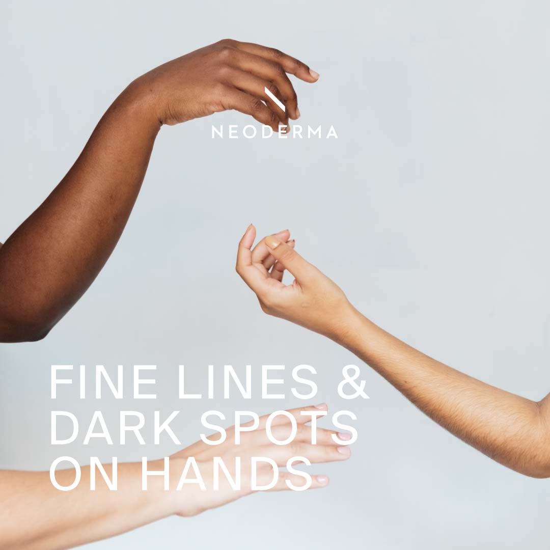 Fine Lines & Dark Spots On Hands – NEODERMA