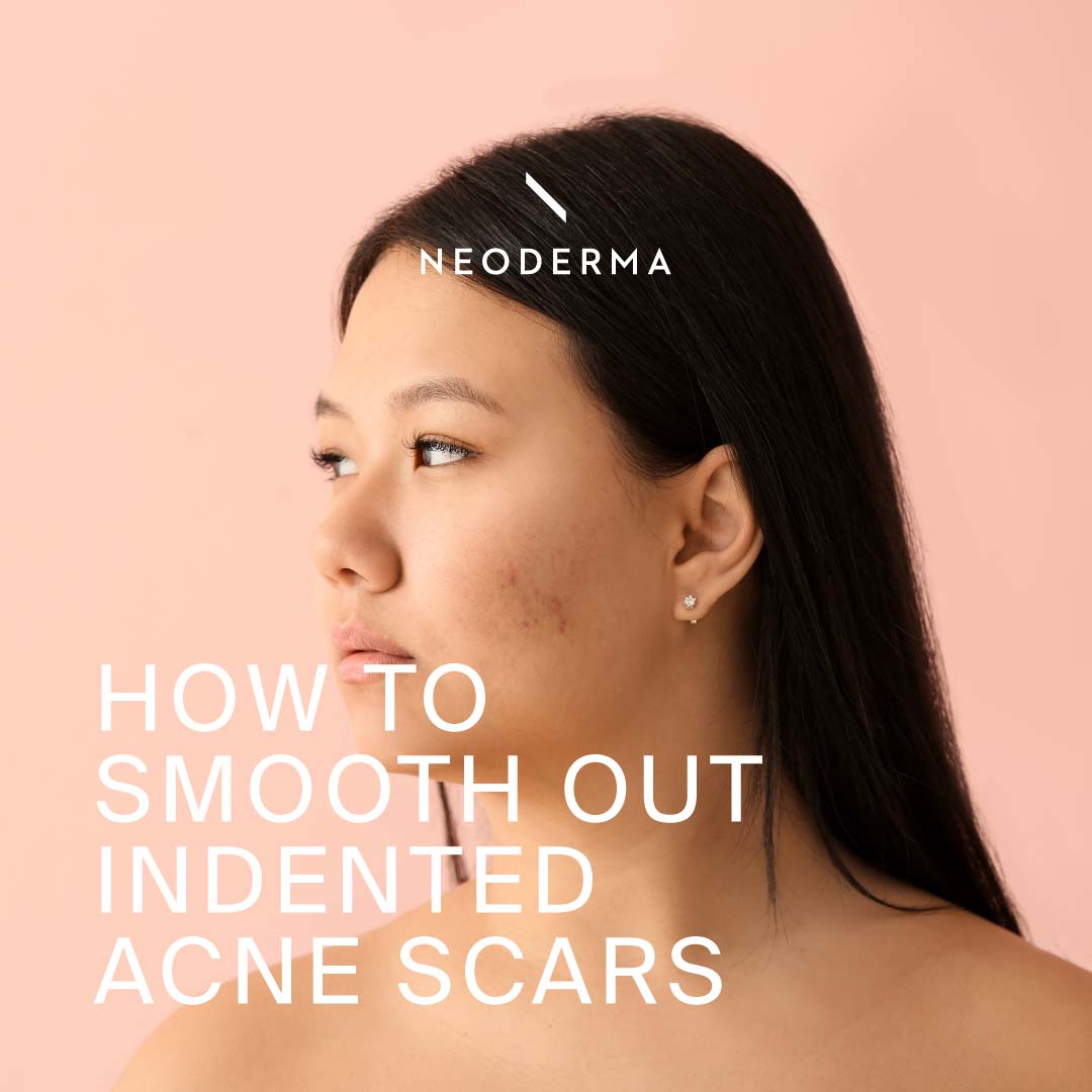 How to Smooth Out Indented Acne Scars – NEODERMA