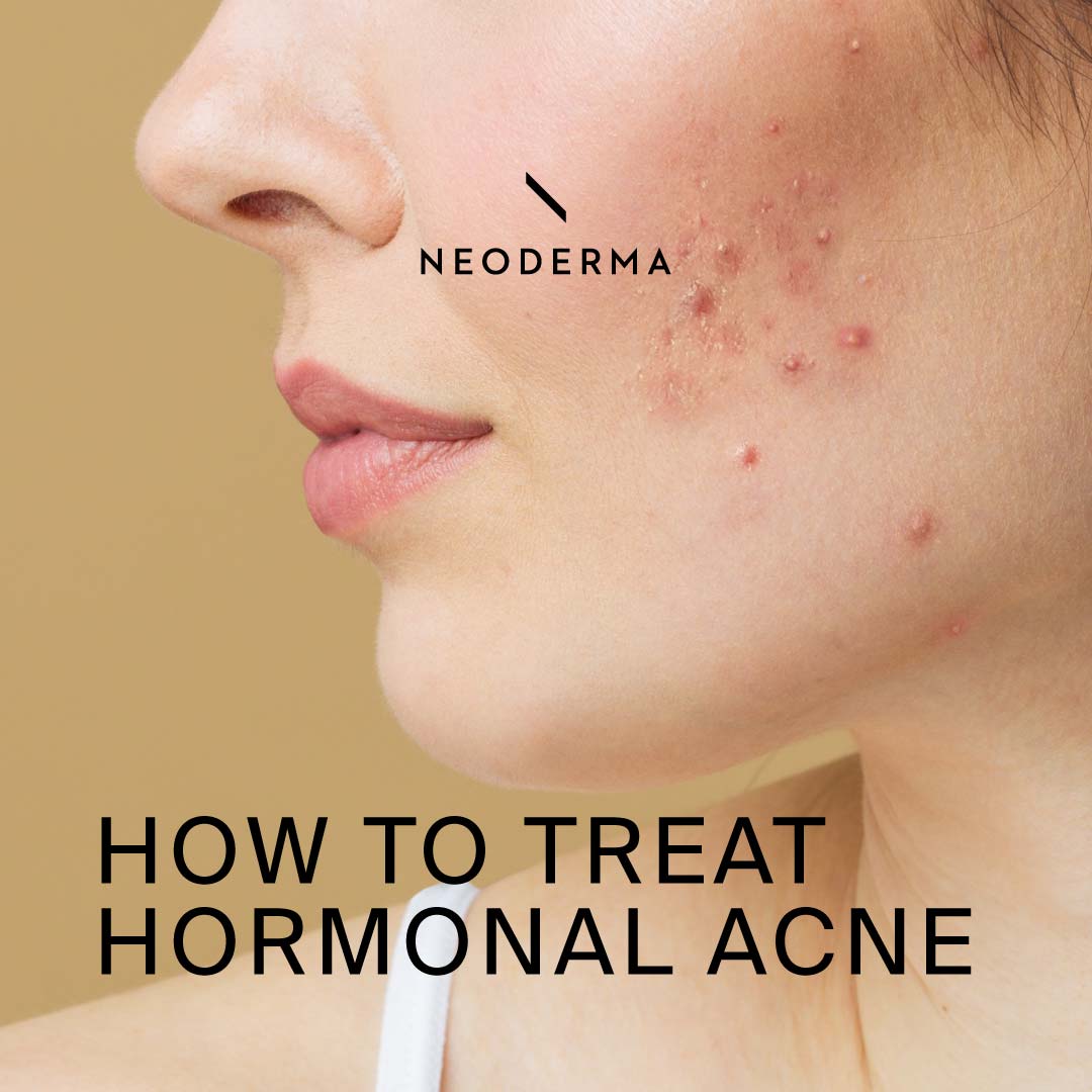 How to Treat Hormonal Acne – NEODERMA