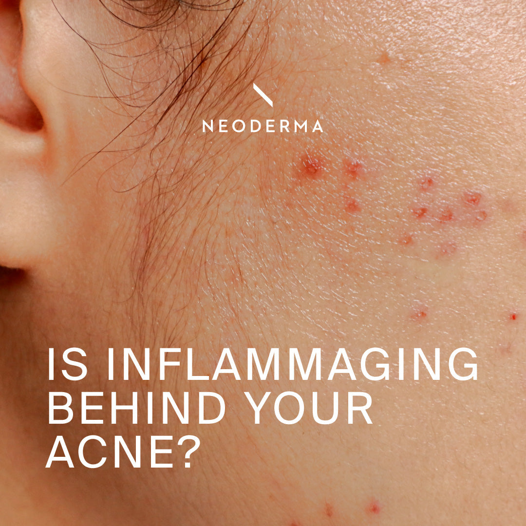 Is Inflammaging the Hidden Cause of Your Acne? | Neoderma – NEODERMA