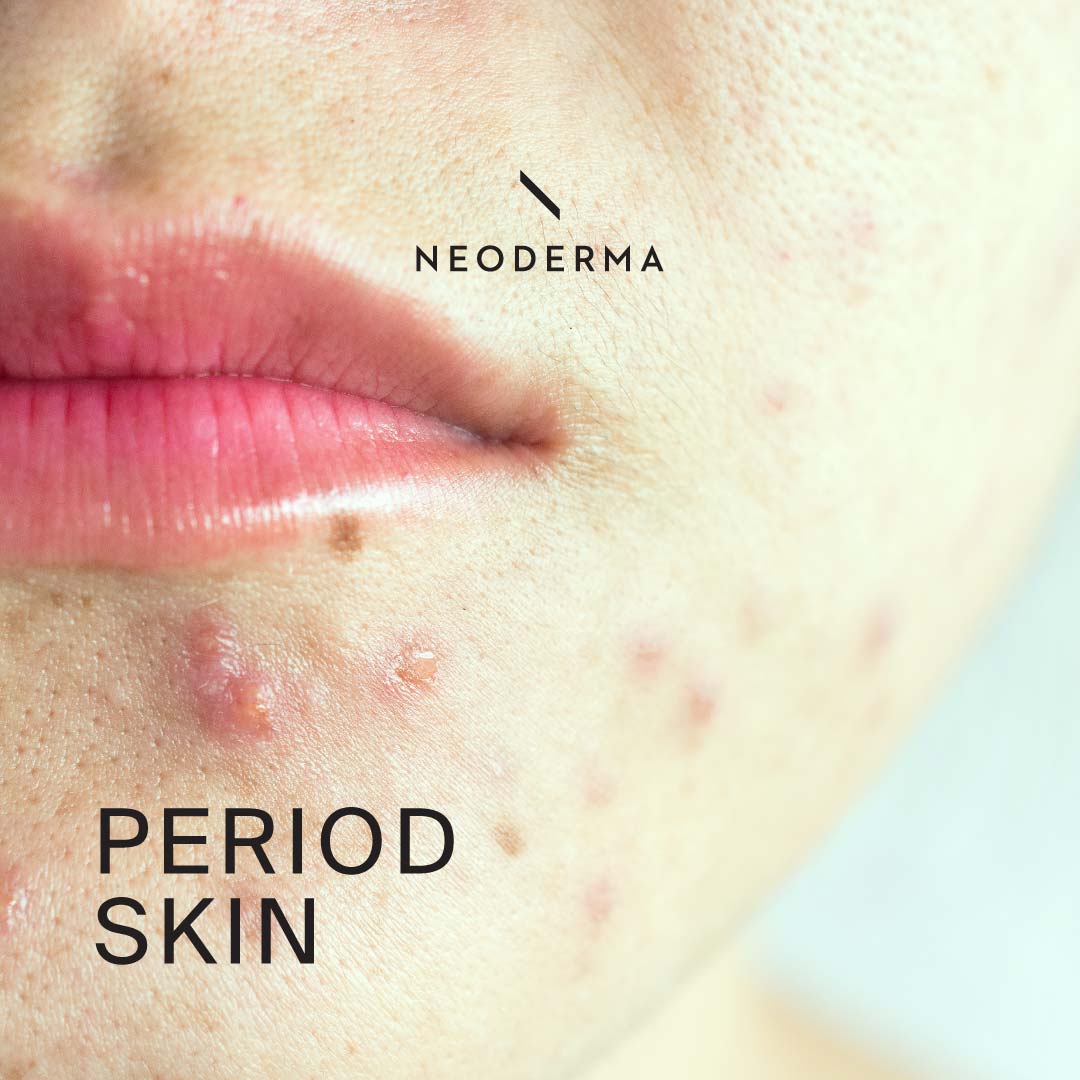 Period Skin Hormonal Fluctuations | NEODERMA