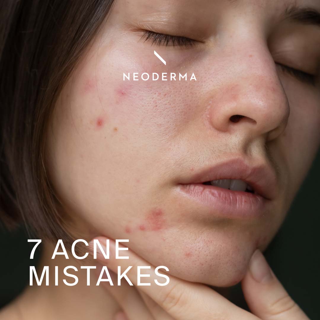 7 Acne Mistakes & Can Stress Cause Acne Breakouts | NEODERMA