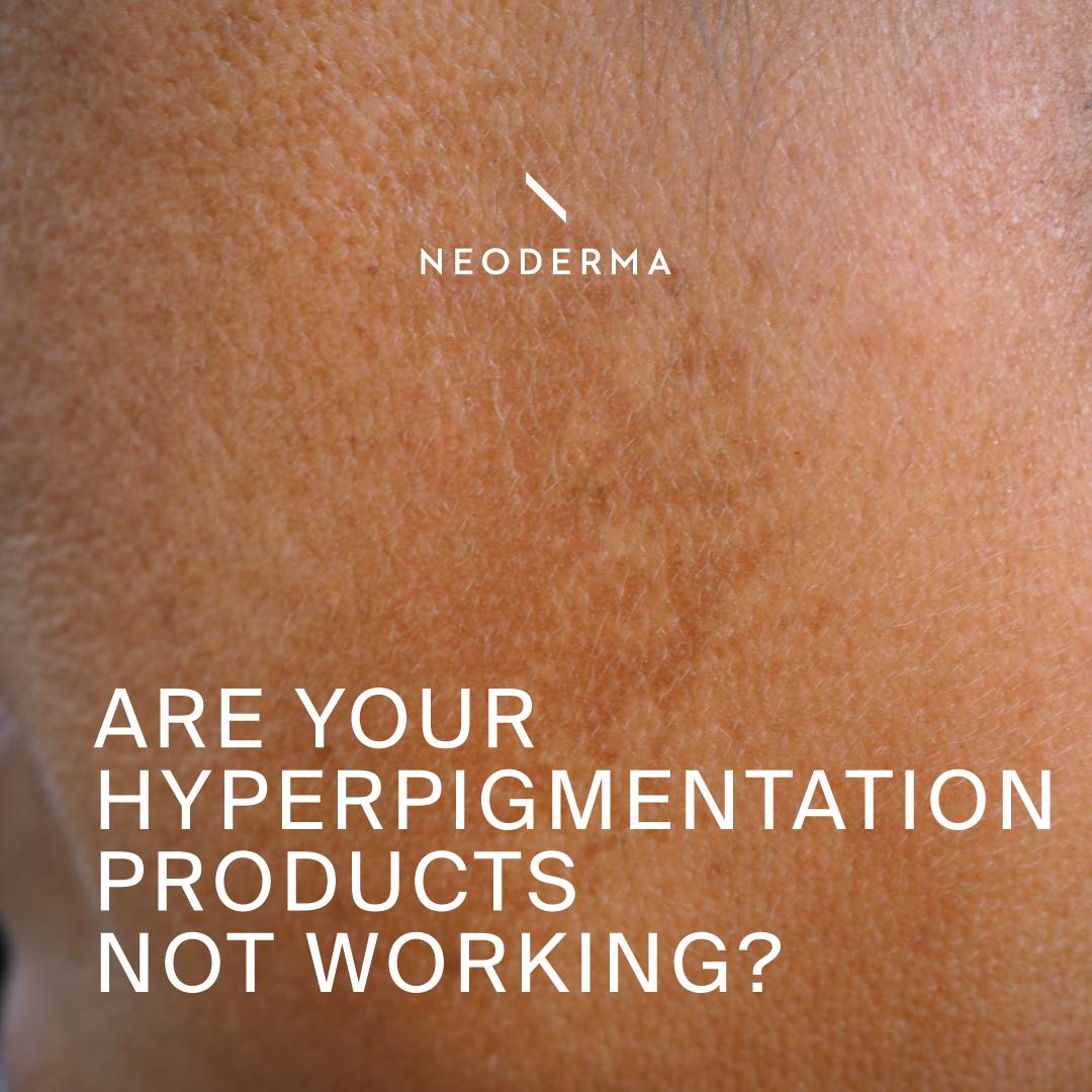 Are Your Hyperpigmentation Products not Working? – NEODERMA