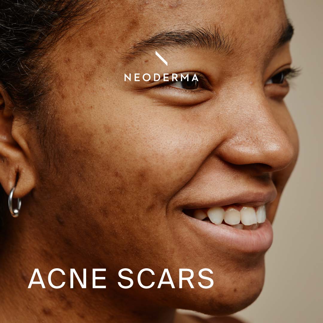 Skin Care For Pitted Acne Scars And Scrub For Acne Prone Skin Neoderma