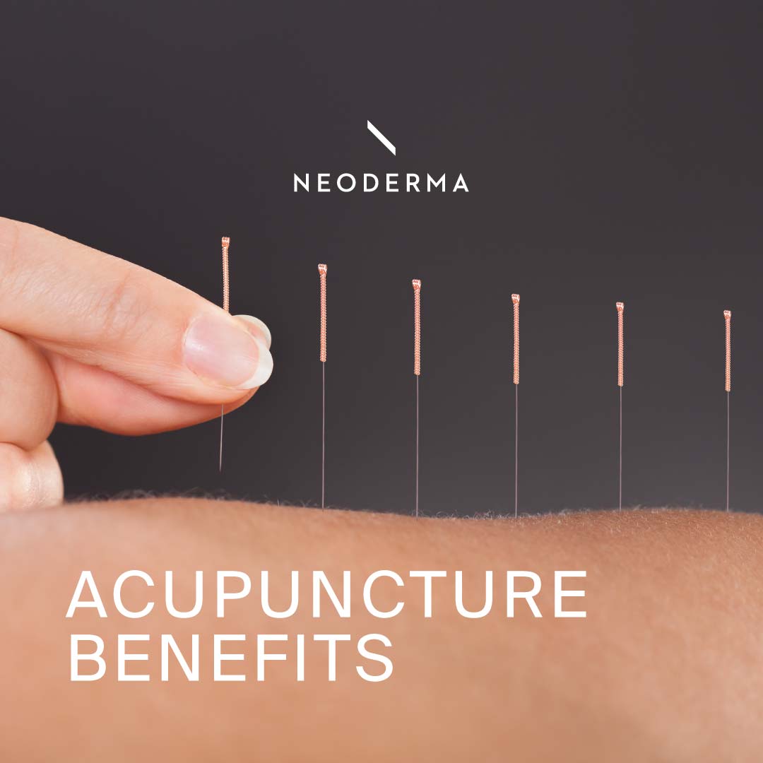 Acupuncture Benefits – NEODERMA