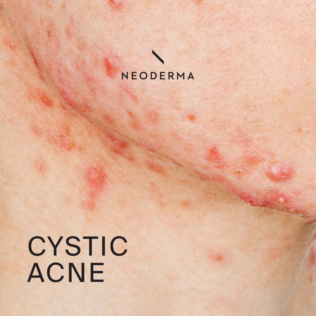 Cystic Acne Skin Types NEODERMA Cystic Acne Skin Types NEODERMA