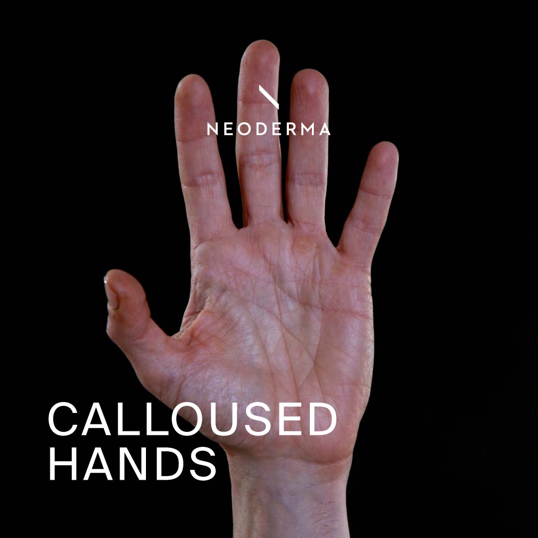 Calloused Hands Skin Cells | NEODERMA