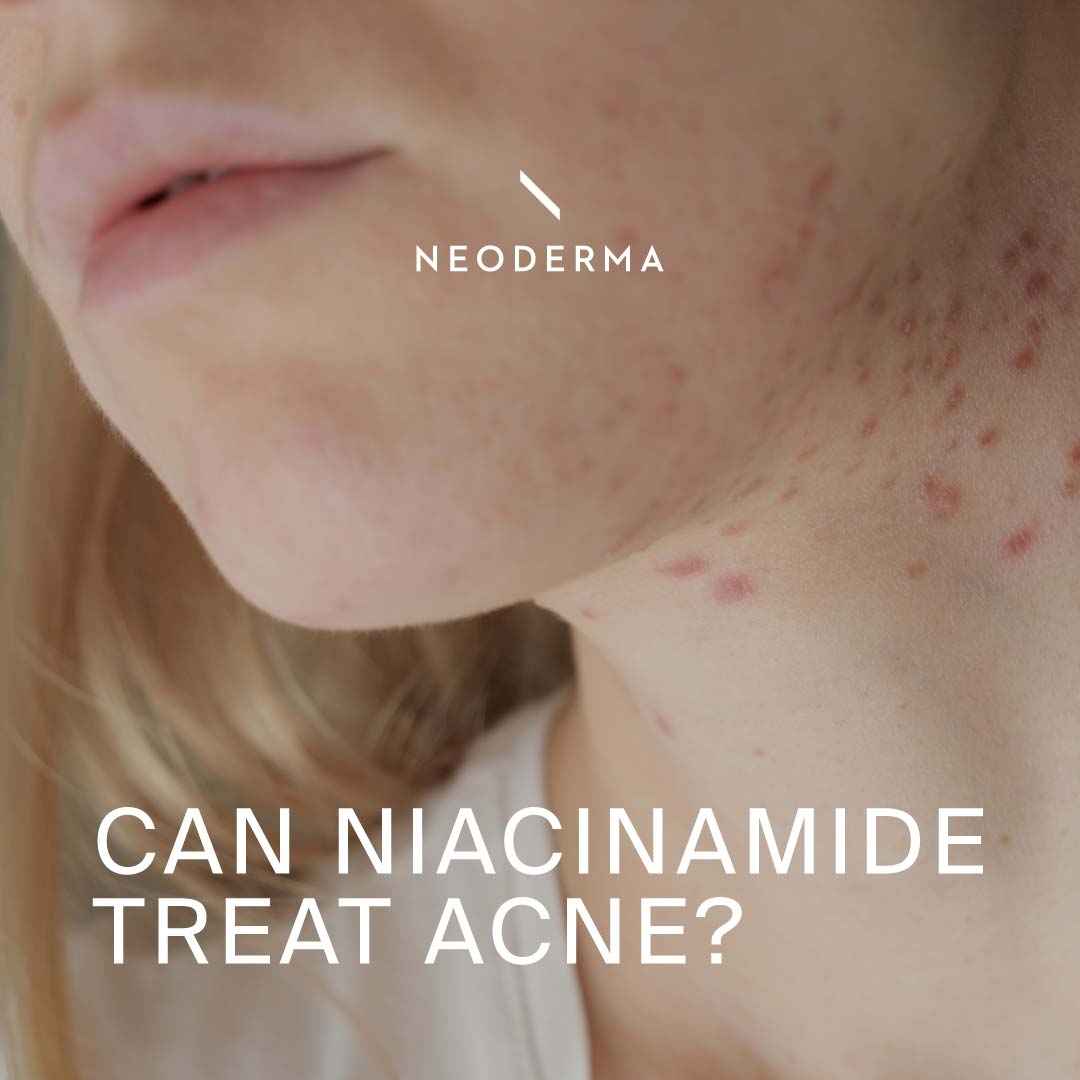 Niacinamide Treat Acne & Airless Skincare | Professional Skincare ...