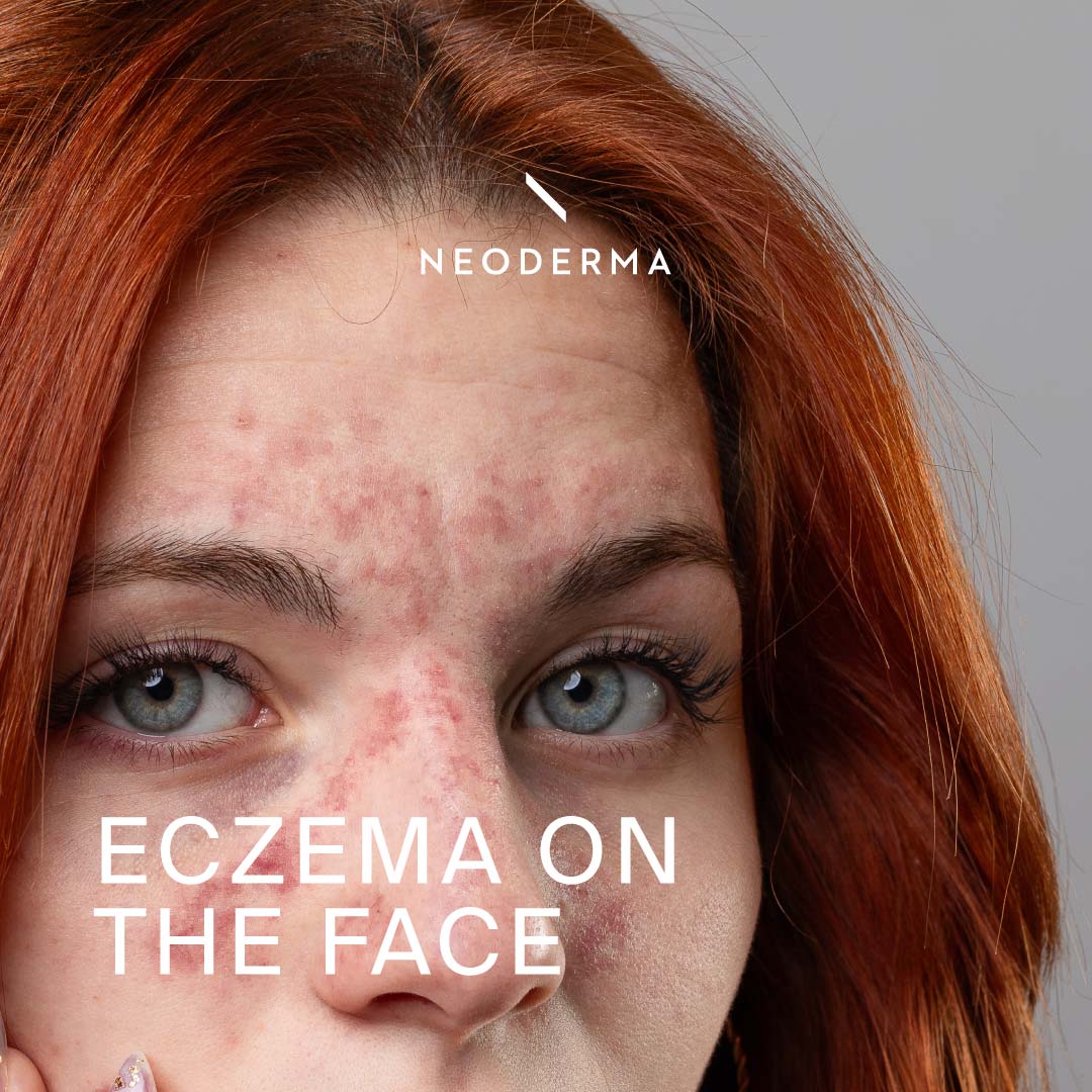 Eczema on the Face and Sensitive Skin Care Products | NEODERMA