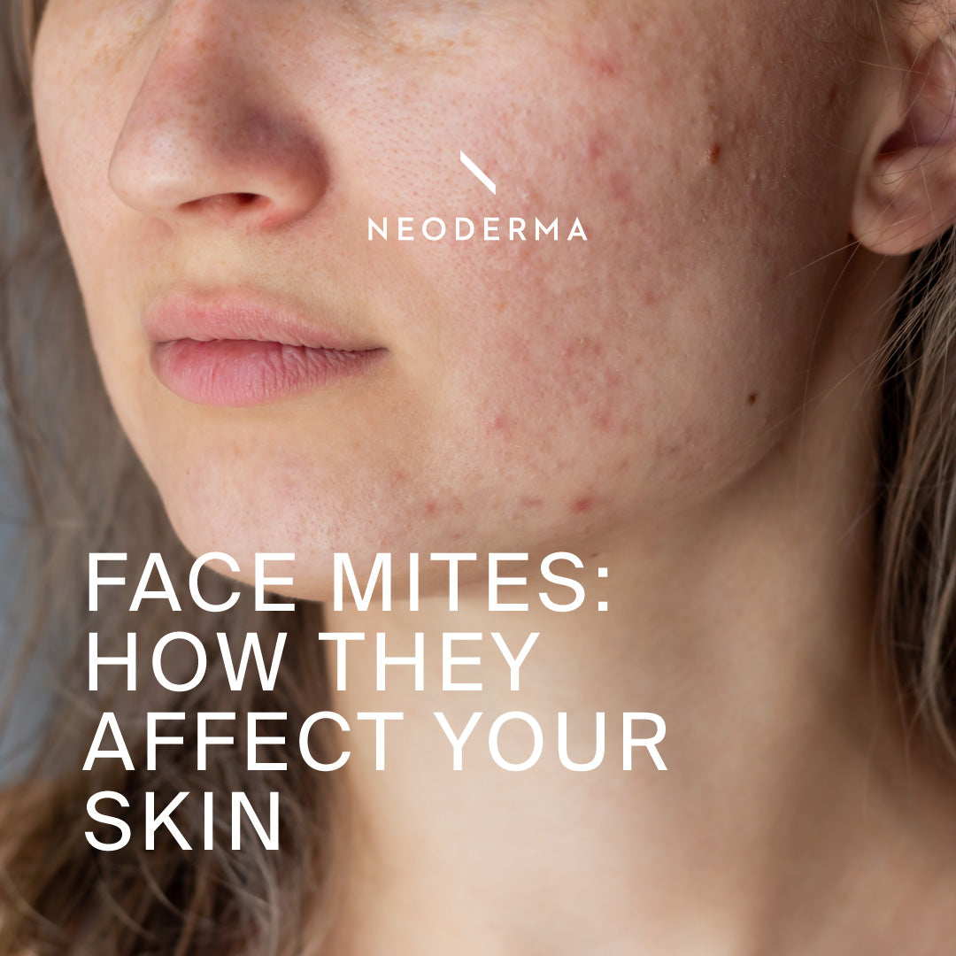 Face Mites: How They Affect Your Skin – NEODERMA