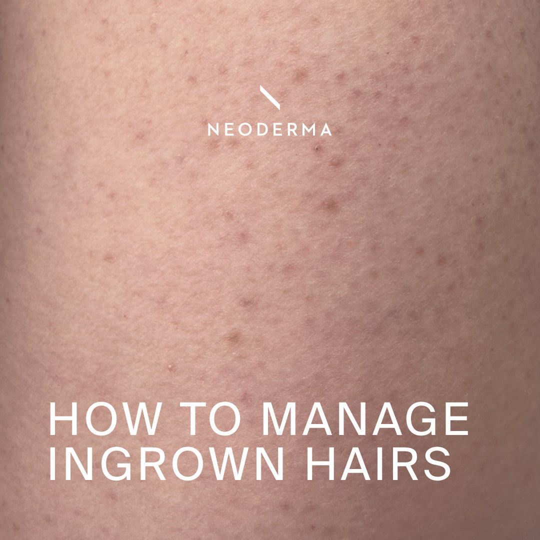 How to Manage Ingrown Hairs – NEODERMA