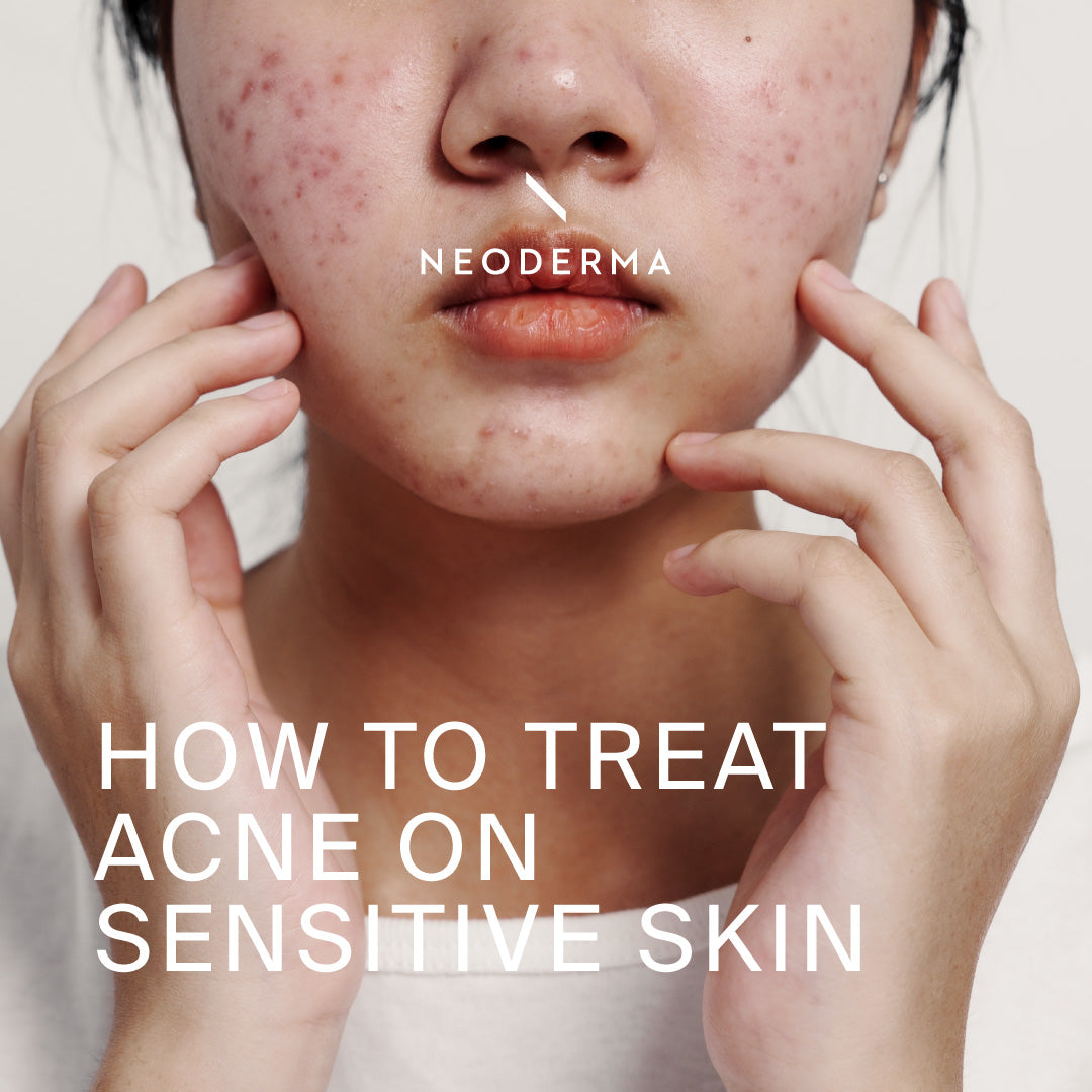 How to treat Acne on Sensitive Skin – NEODERMA