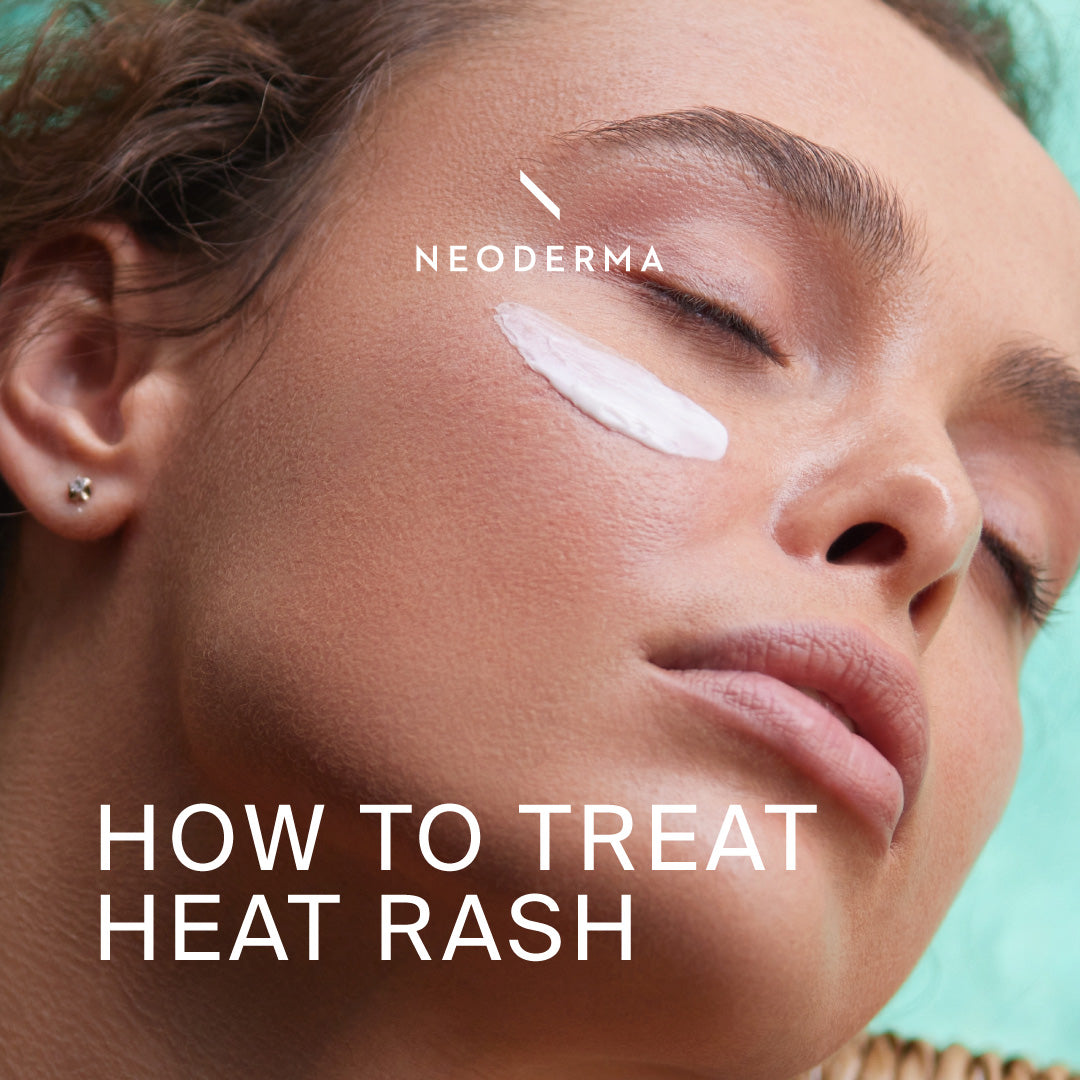 How to treat Heat Rash – NEODERMA