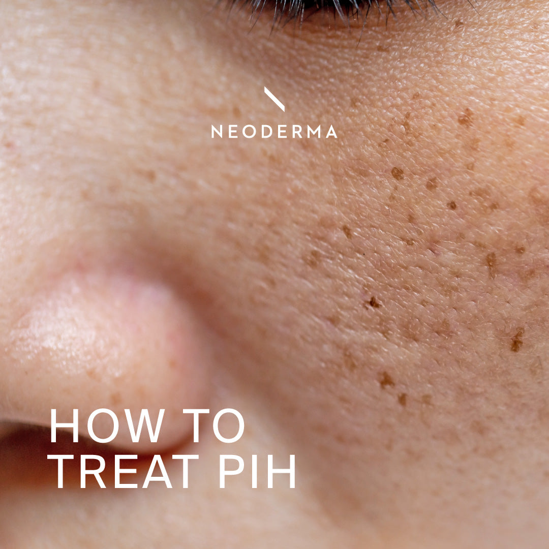 How to Treat Pih Treatment and Natural Skin Care Products | NEODERMA