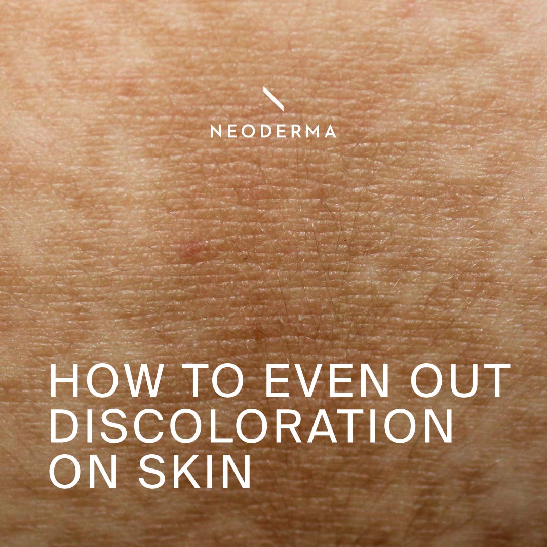 How to Even Out Discoloration on Skin – NEODERMA