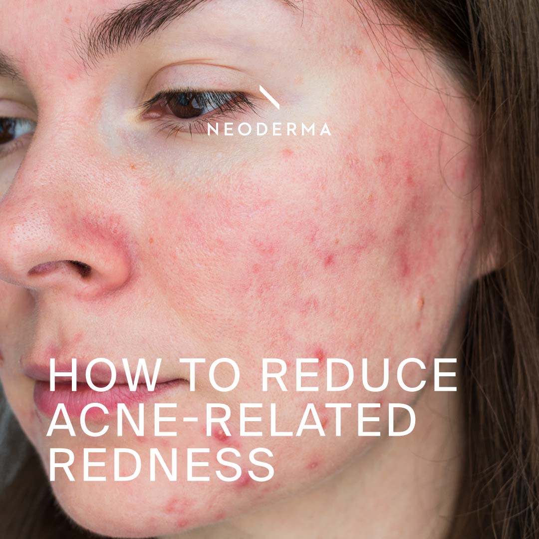 How to Reduce Acne-Related Redness – NEODERMA