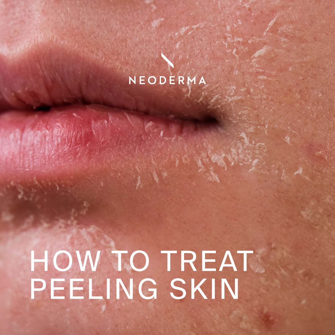 How to Treat Peeling Skin? – NEODERMA