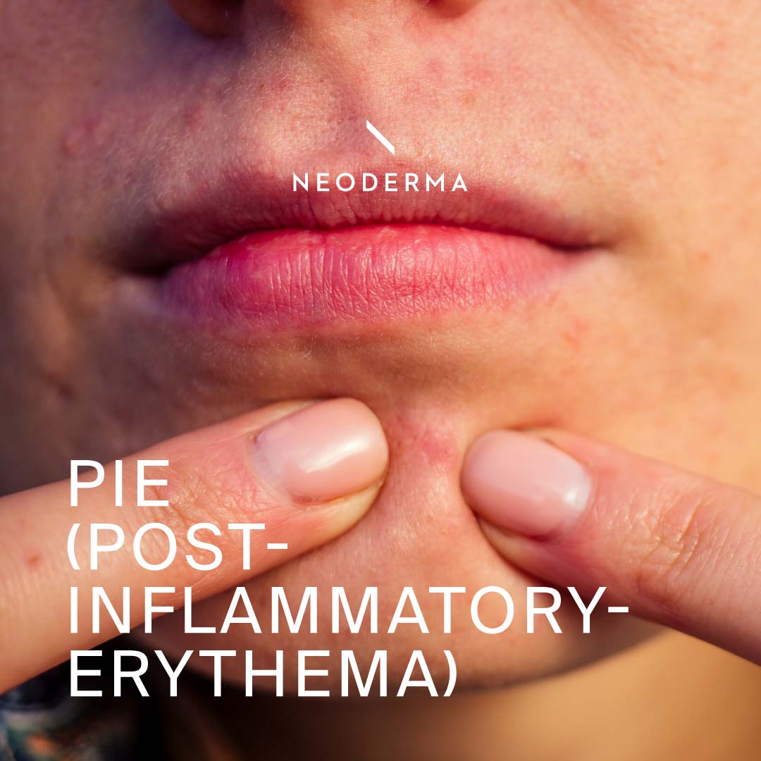 PIE (Post-Inflammatory-Erythema) – NEODERMA