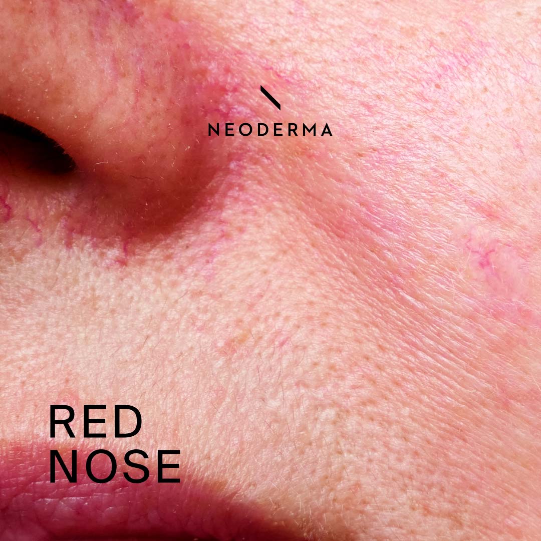 Red Nose Dermatologist | NEODERMA