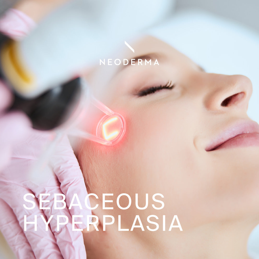 Sebaceous Hyperplasia – NEODERMA