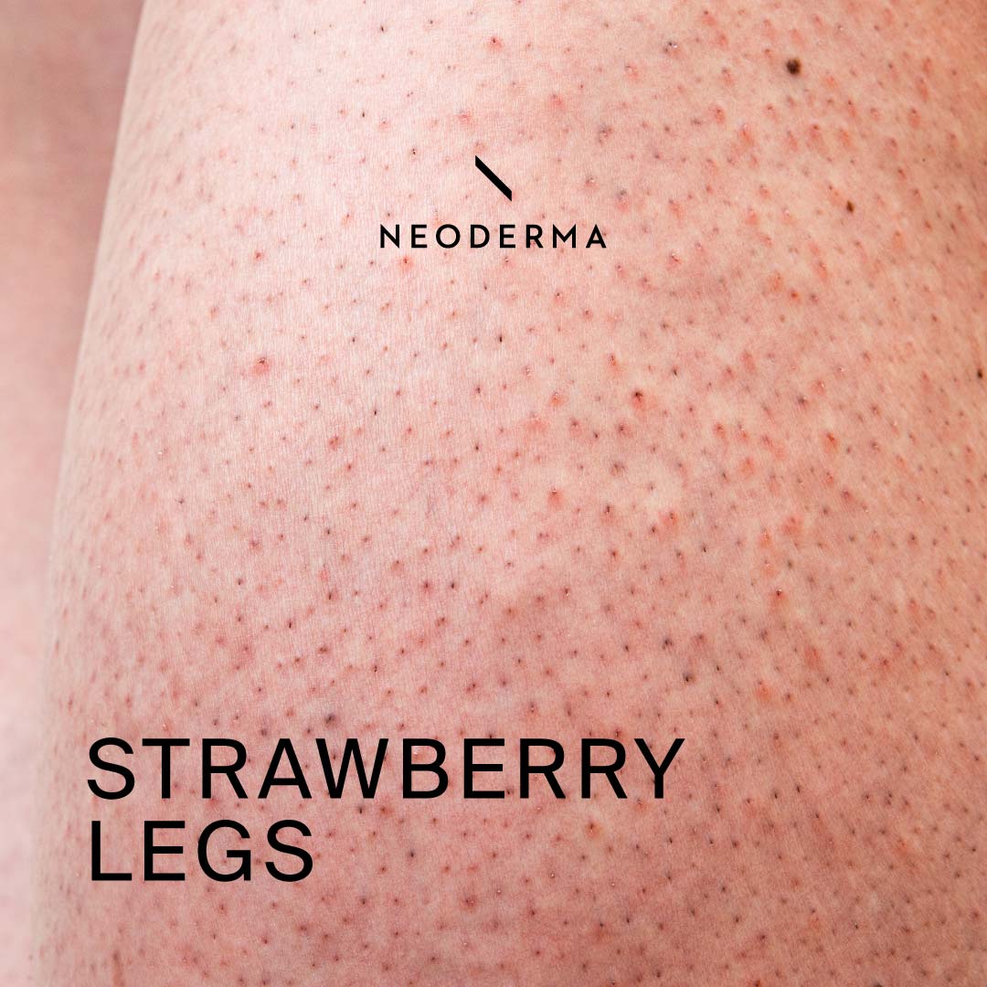Strawberry Legs Treatment | NEODERMA
