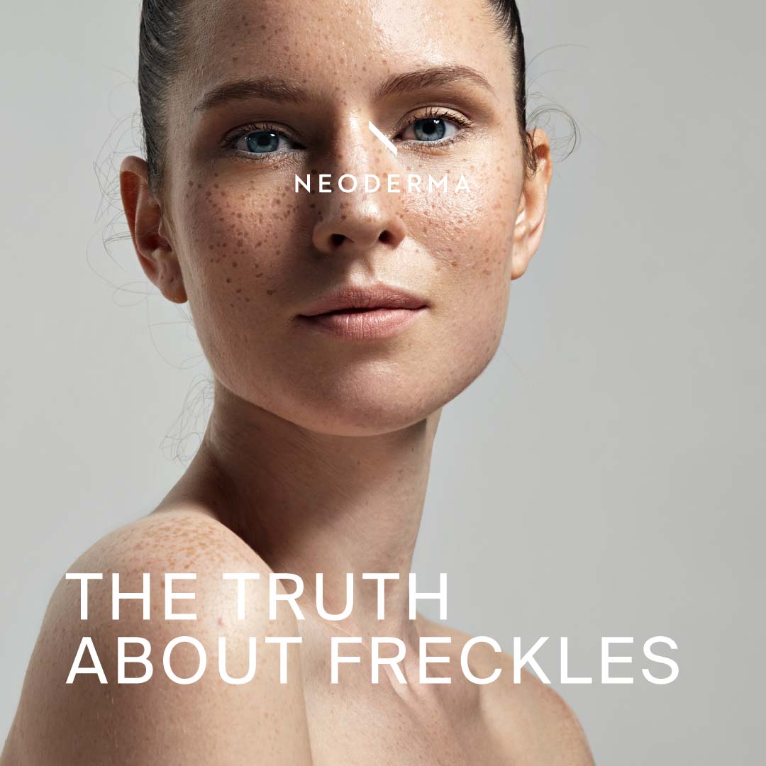 The Truth About Freckles – NEODERMA