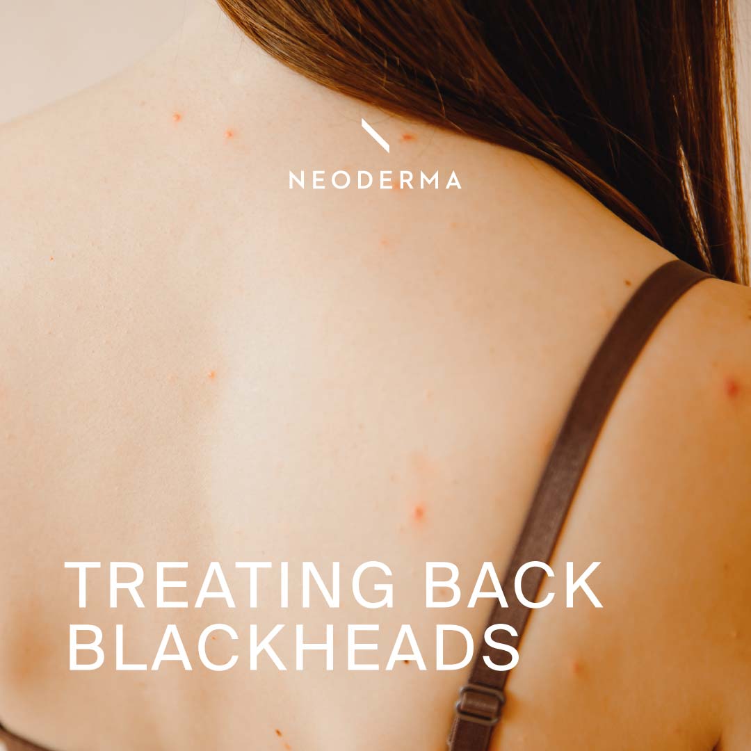 Treating Back Blackheads – NEODERMA