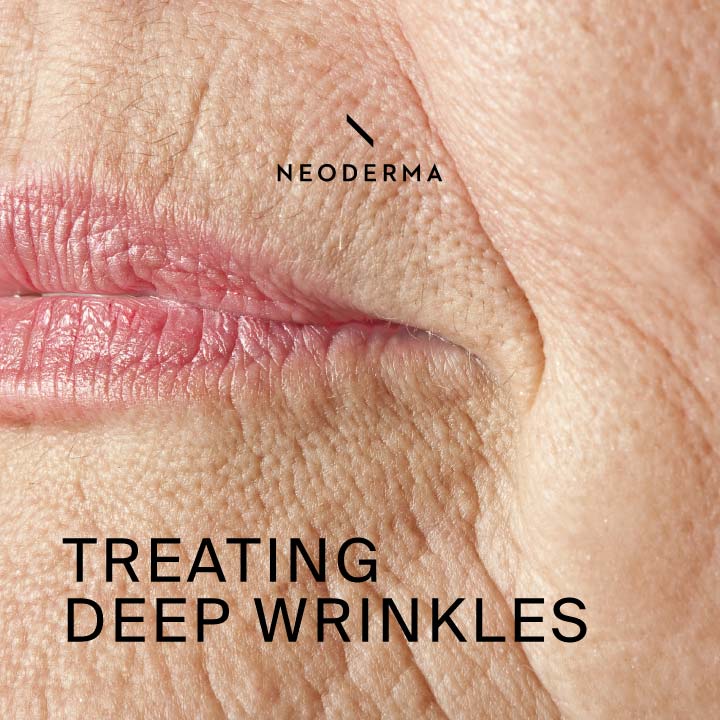 Treating Deep Wrinkles – NEODERMA
