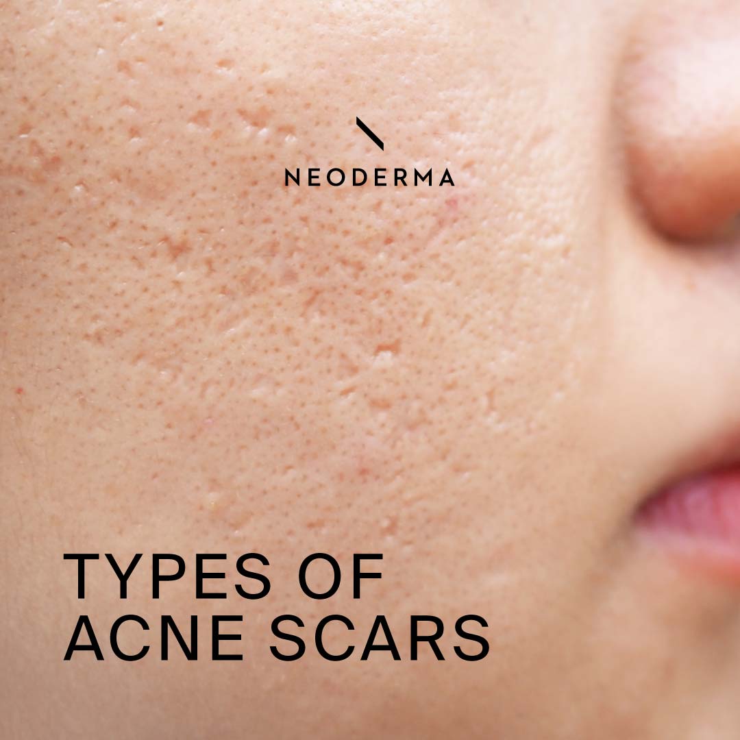 Types of Acne Scars – NEODERMA