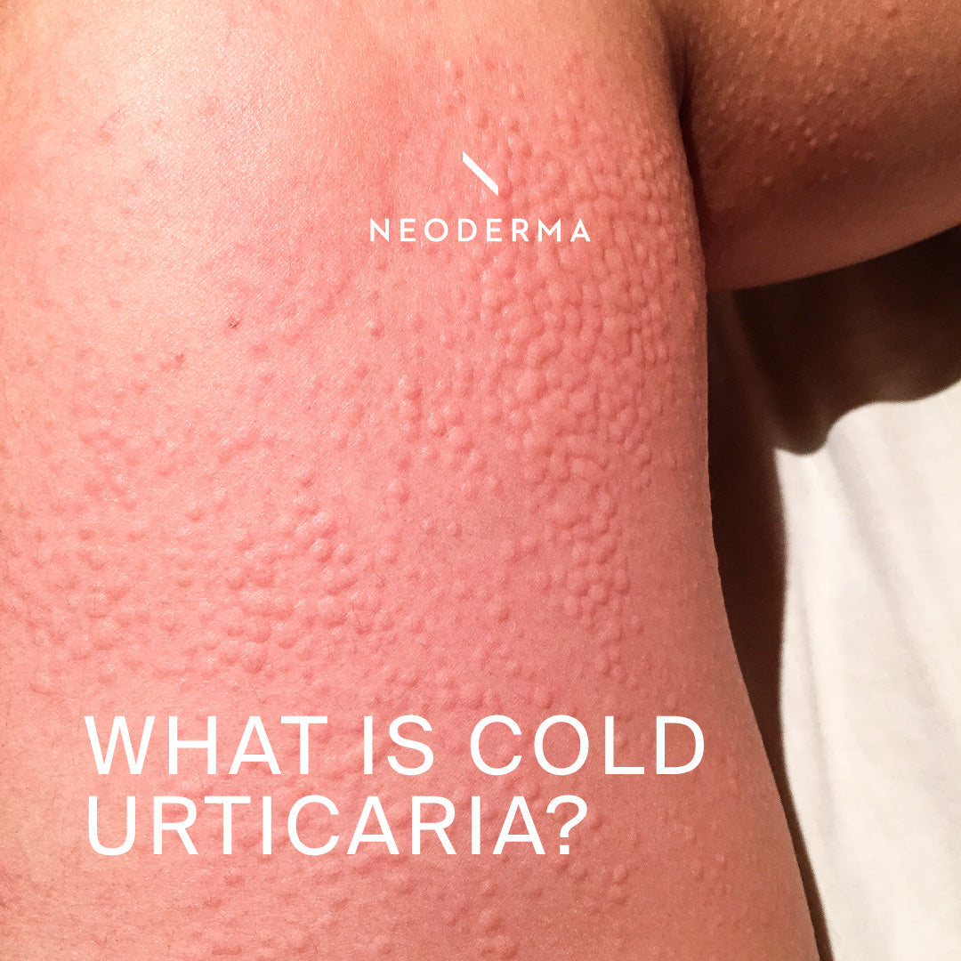 What is Cold Urticaria? – NEODERMA