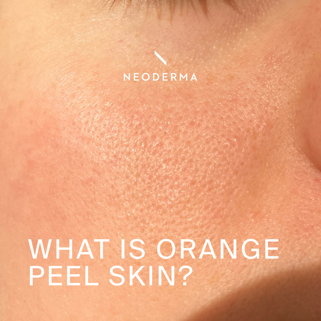 What is Orange Peel Skin? – NEODERMA