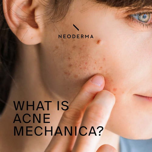 Acne Mechanica Treatment on Face and Skin Care Cream | NEODERMA
