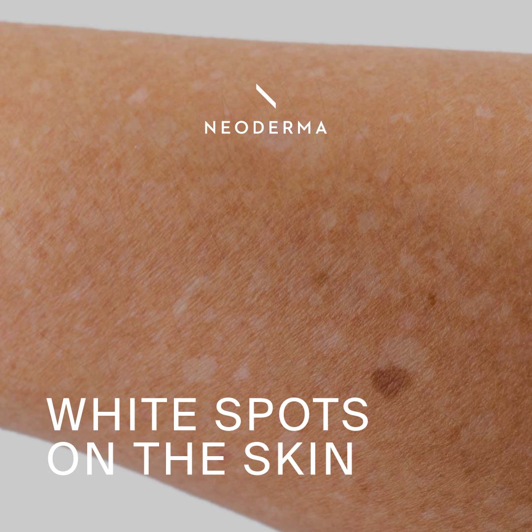 White Spots on the Skin – NEODERMA