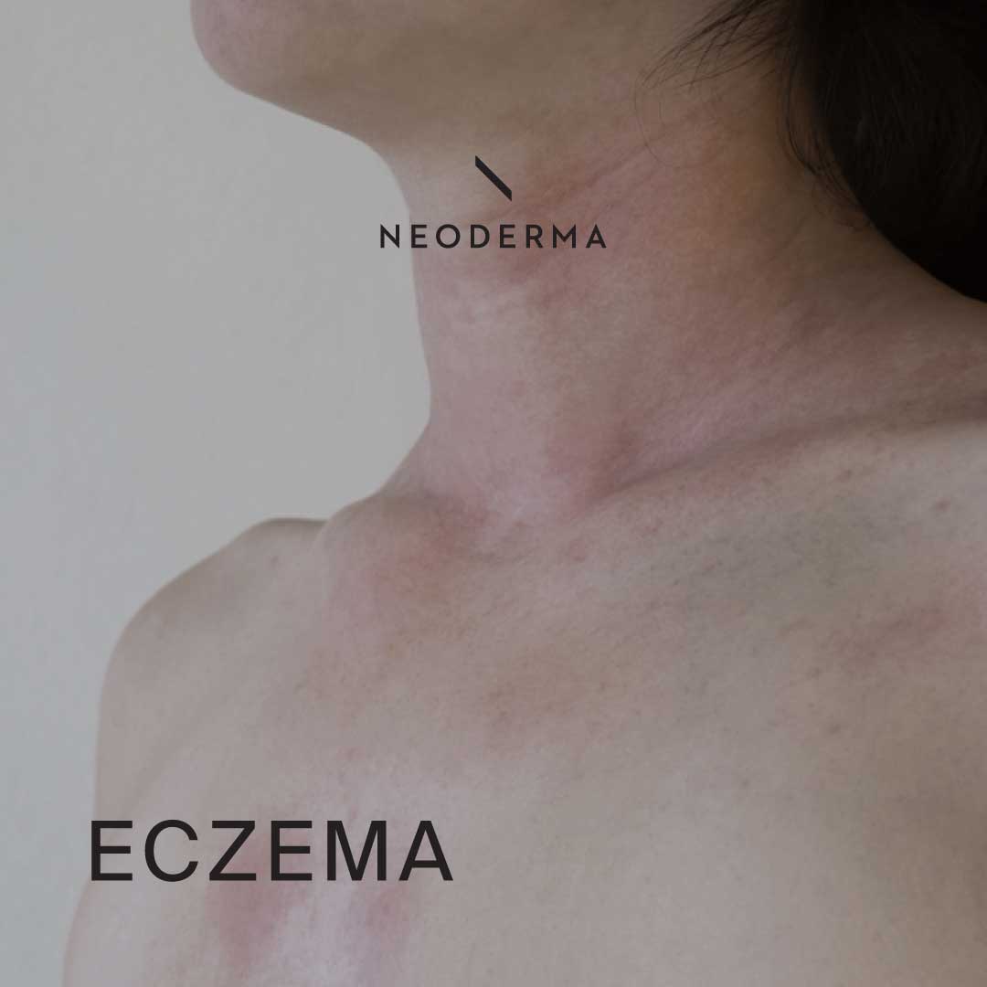 Eczema Skin Treatments | NEODERMA